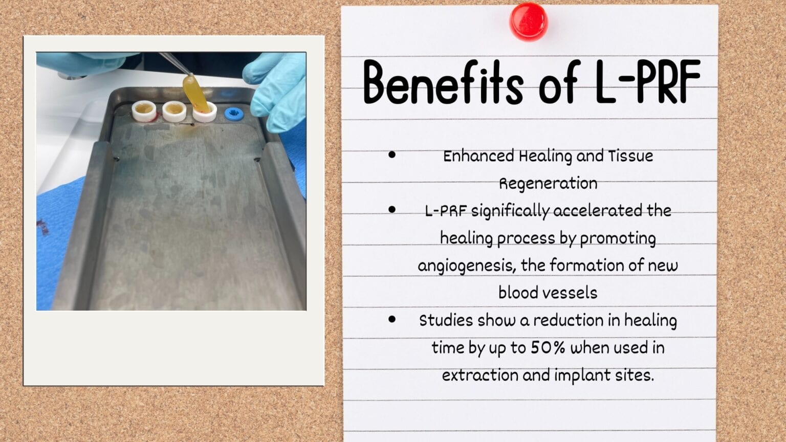 What is Leukocyte-Platelet Rich Fibrin? - Potomac Dental Centre