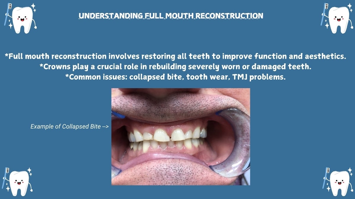 Restoring a Collapsed Bite with Crowns - Potomac Dental Centre