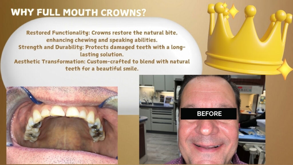 Restoring a Collapsed Bite with Crowns - Potomac Dental Centre